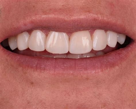 Resina Dental Qué es cuánto cuesta cuánto dura Conocelo todo