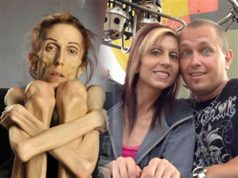 Woman Suffering From Anorexia Rachael Farrokh S Road To Recovery