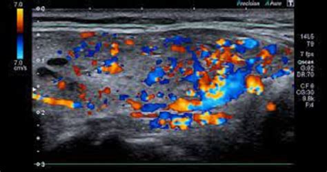 Eco doppler tiroides Resobert Medicina Radiología