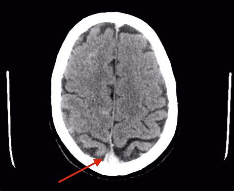 Extensive Cerebral Venous Thrombosis As An Isolated Presentation In A