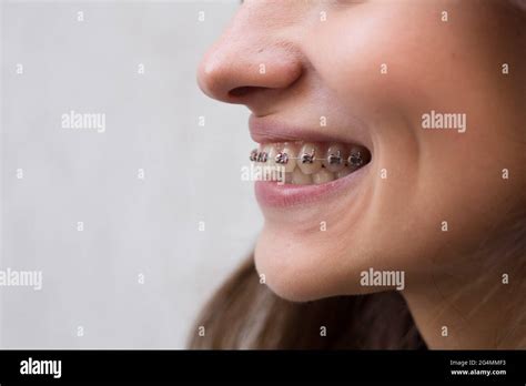 Beautiful People With Braces
