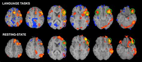 active and passive fmri for presurgical mapping of motor and language cortex intechopen