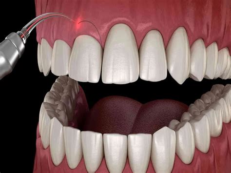 مراقبت های بعد از جراحی لیفت لثه کلینیک دردیس