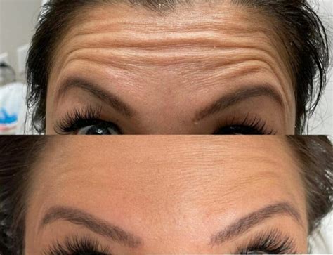 Tratamento para Rugas Antes e Depois Clínica Fit Body Estética