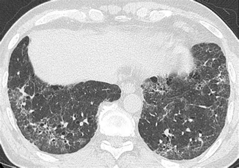 Interstitial Lung Disease Honeycombing