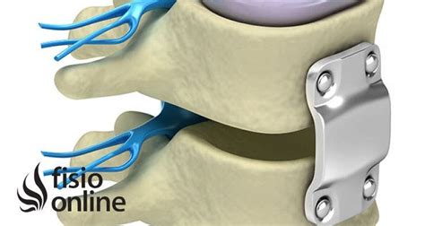 Artrodesis lumbar Qué es indicaciones riesgos y tratamiento