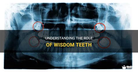 Understanding The Role Of Wisdom Teeth MedShun
