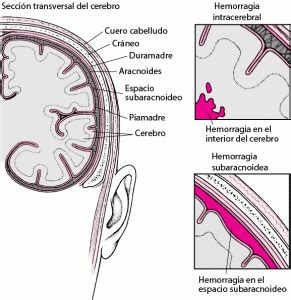 Hemorragia subaracnoidea Definición y causas NeuroAiD