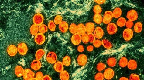 Suécia registra primeiro caso de nova variante da mpox fora da África