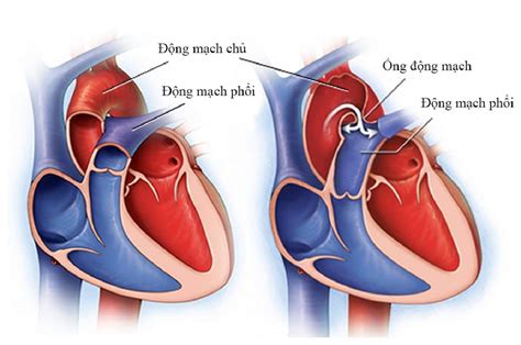 Tìm hiểu dấu hiệu bệnh tim ở trẻ sơ sinh và cách phòng ngừa