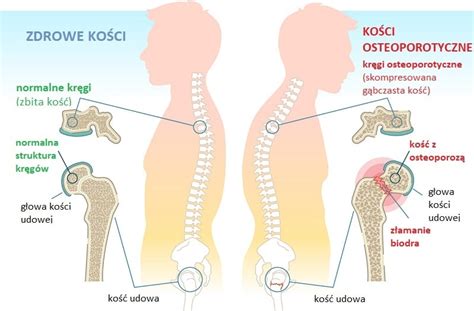 Osteoporoza Co To Jest Objawy Przyczyny I Leczenie