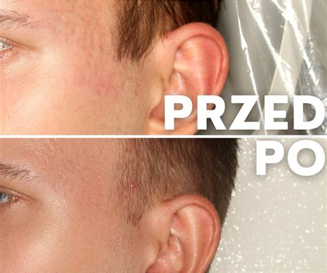 Efekty zabiegów LASERMED LASERMED