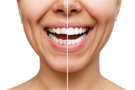 How To Take Care Of Veneers