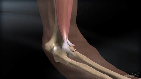 Arthrex Distal Biceps Repair Using The Bicepsbutton And Tension