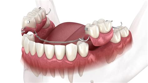Tipos de prótese dentária conheça aqui todos os modelos