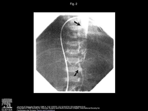 Neonatal Thoracoabdominal Aortic Thrombosis Associated With The