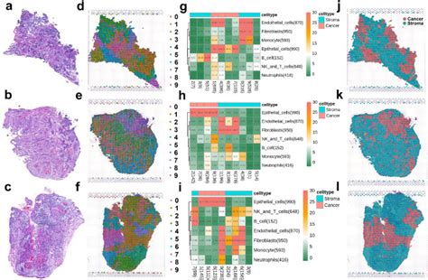 integrating microarray based spatial transcriptomics and single cell rna sequencing reveals