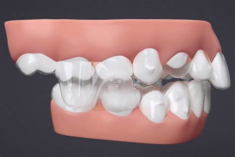 Invisalign para avance mandibular o corrección de la clase II Gaceta