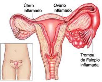 Infecciones Del Aparato Genital Femenino Mind Map
