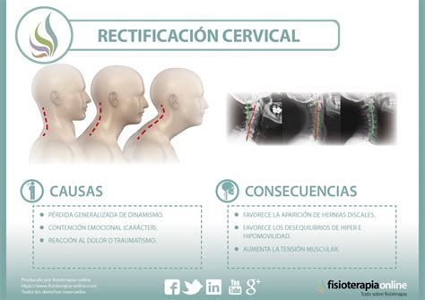 Rectificación cervical Qué es causas síntomas tratamiento y