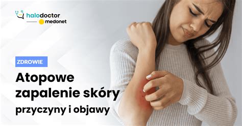 Atopowe zapalenie skóry czym jest i jak je leczyć