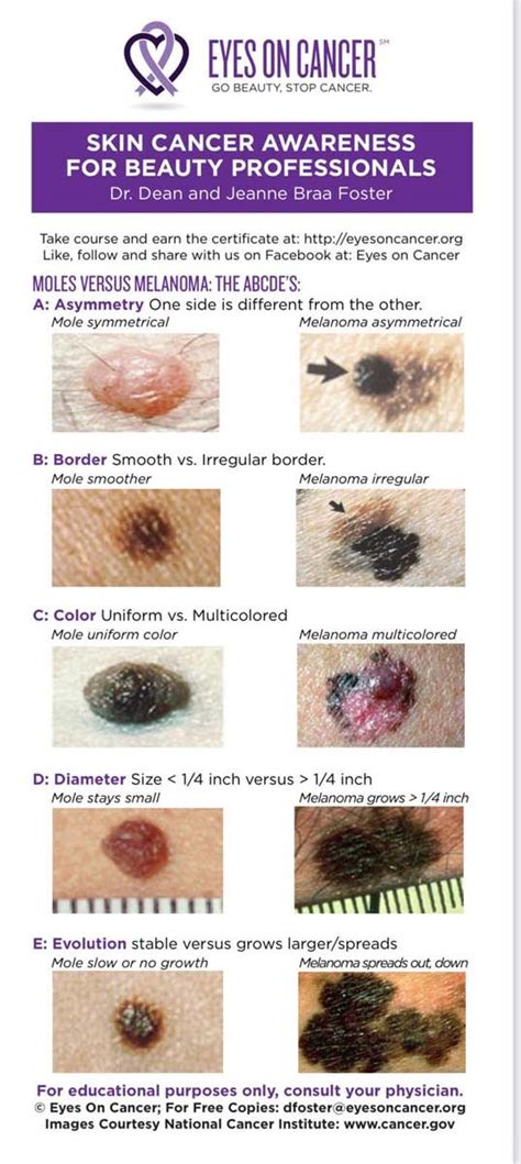 Eyes On Skin Cancer Belle Ame