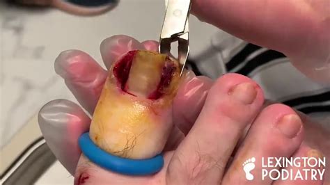DEEP BLOODY INGROWN TOENAIL YouTube