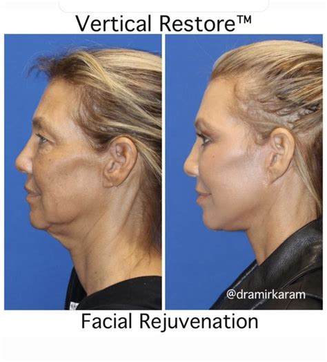 Pin By Sarah Willey On Before And Afters Facial Rejuvenation