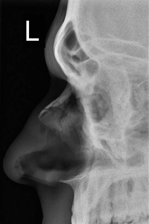 Broken Nose Nasal Fracture Storymd