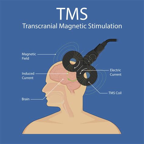 TMS Therapy And Treatment Pros Cons HealingMaps