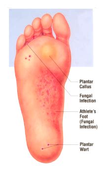 Plantar Wart Root Diagram Bruin Blog
