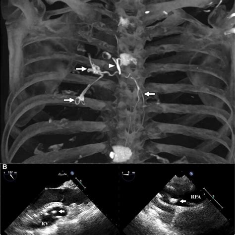 A The Three Dimensional CT Reconstruction Demonstrated A