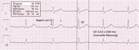 Qtcf Interval