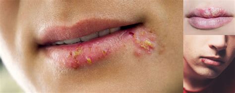Herpes Labial Porqué sale Contagio Síntomas y Tratamiento Efectivo