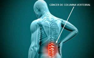C Ncer De Columna Vertebral S Ntomas Causas Y Tratamiento