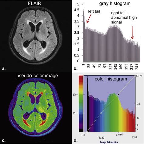 automatic segmentation and quantitative analysis of white matter hyperintensities on flair