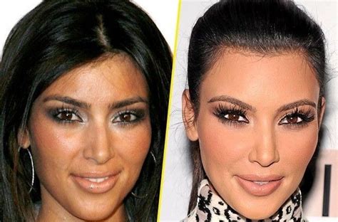 La beauté des stars exaltée par la chirurgie esthétique