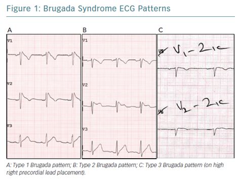 Brugada Syndrome ECG Patterns Radcliffe Cardiology