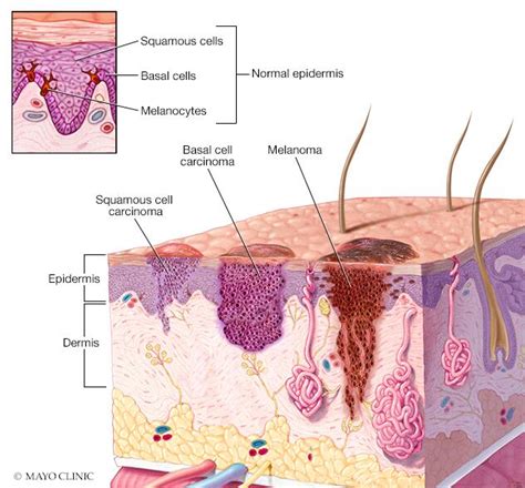 Carcinoma De C Lulas Basales Carcinoma De C Lulas Basales S Ntomas Y