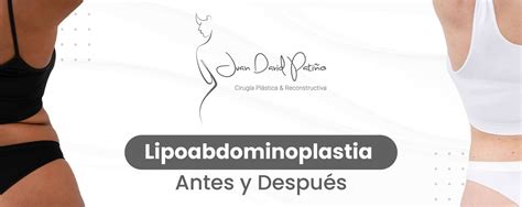 Conoce todo sobre la abdominoplastia I Dr Juan David Patiño