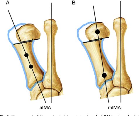 Figure 2 From Proximal Intermetatarsal Divergence In Distal Chevron