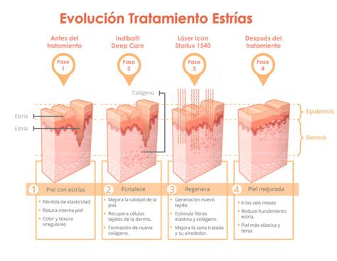 Estrías Blancas Dermaline