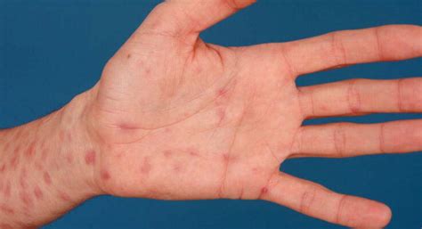What Are The Symptoms Of Syphilis Rash And The Treatment For Syphilis