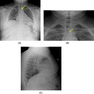 Chest Radiograph Posterioranterior A B And Lateral Views C