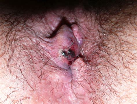 Thrombosed Hemorrhoid Skin Tag