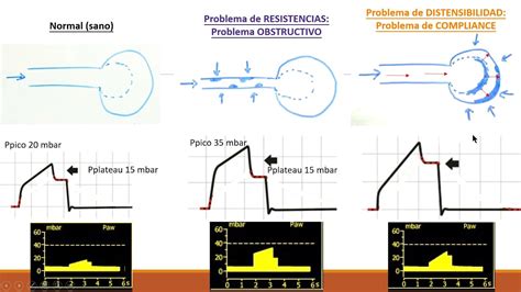 Gráfica presión tiempo en ventilación controlada por volumen Oxylog