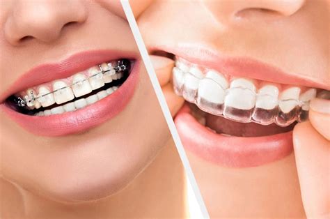 Ortodoncia Invisible Invisalign O Smile Direct Club Dental Galindo