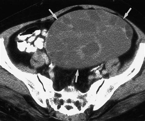 CT And MR Imaging Of Ovarian Tumors With Emphasis On Differential