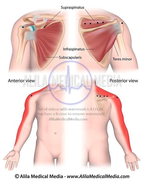 Alila Medical Media Trigger Points And Referred Pain Patterns For The