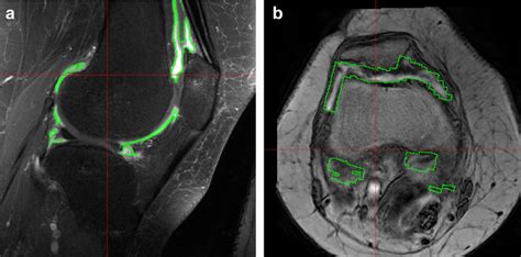 A Sagittal Post Contrast T1 Weighted Fat Suppressed Turbo Spin Echo